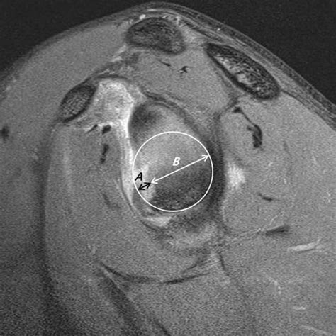Measurement Of Glenoid Bone Loss Using The Best Fit Circle Method In