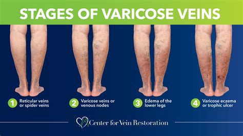 Learn About Varicose Veins And Treatments Center For Vein Restoration