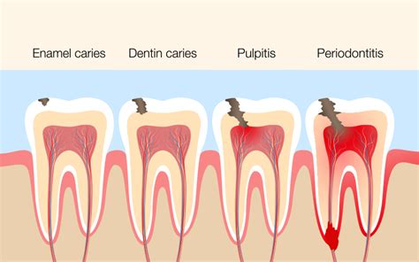 Periodontal Gum Disease Treatment In Nyc Greenwich Village 10014