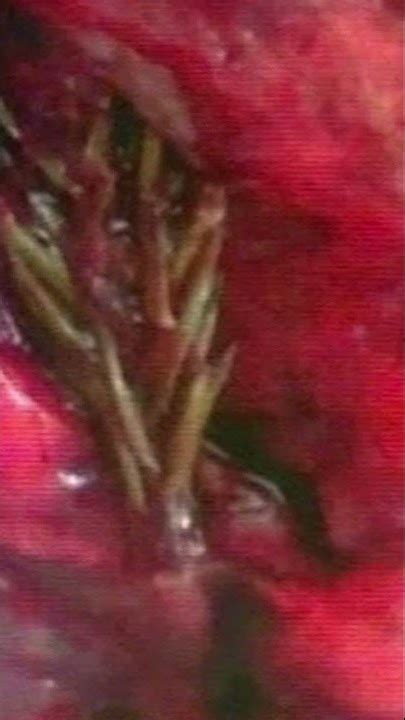 Tree Grows Inside Mans Lung Too Strange To Be True Artyom Sidorkin
