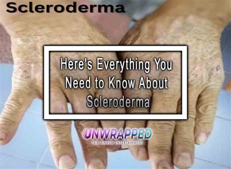 Heres Everything You Need To Know About Scleroderma