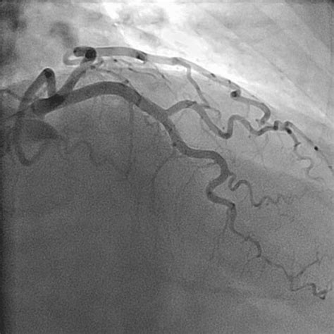 Heart Catheterization False Positive At Scarlett Tenison Woods Blog