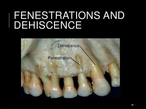 Periodontal Bone Defects