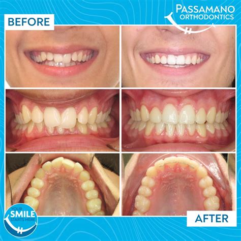 Braces With Permanent Retainer Wire Nice Result Passamano Orthodontics