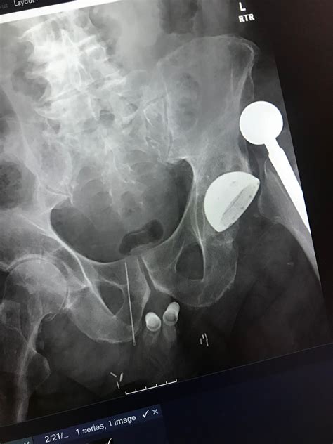 A Radiation Risk Calculator That I Use Often When Patients Are Worried About