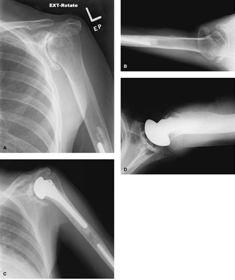 Dip Dislocation Teachme Orthopedics
