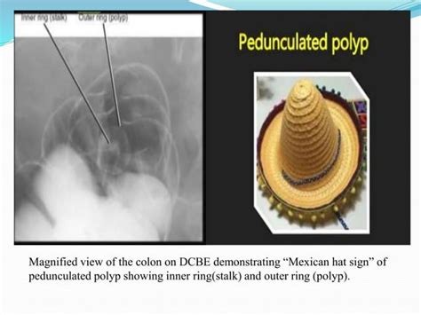 Imaging Of Large Bowel Polyp Pptx Digestive Disorders Diseases
