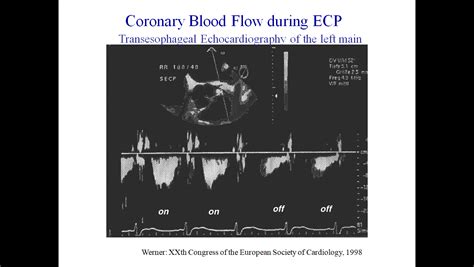 Ecp External Counter Pulsation Genopdes