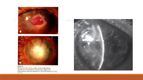 A Presentation On Infective Bacterial Keratitispptx Eye And Vision