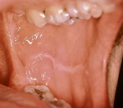 Benign Chronic White Lesions Of The Oral Mucosa Md Searchlight