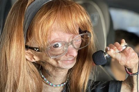 Progeria Adalia Rose 2022