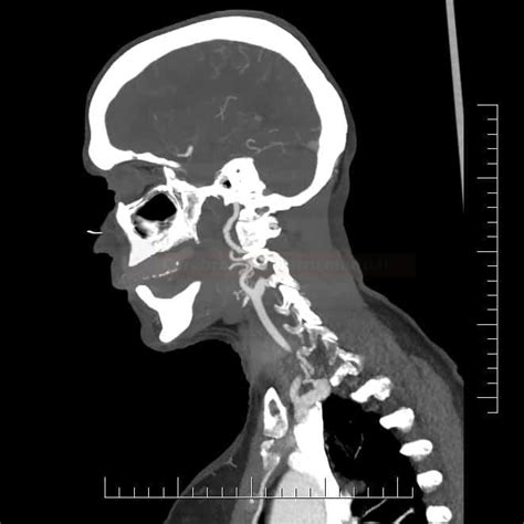 Fibromuscular Dysplasia Fmd Stroke Manual