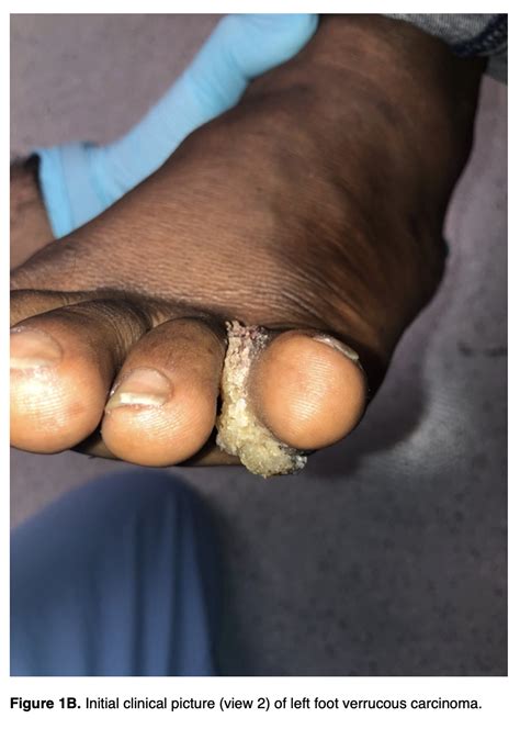 When Pedal Verruca Vulgaris Is Actually Verrucous Carcinoma Podiatry Today