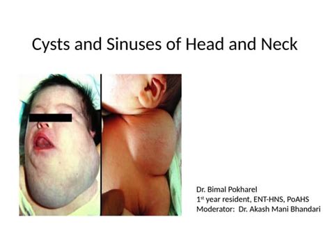 Cysts And Sinus Of Neck In Head And Neck Cancer Pptx