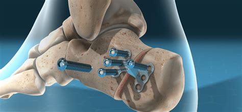 Calcaneal Osteotomy Including Prosthetic Implant Surgical Cubaheal