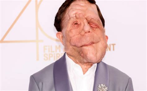 Adam Pearson Jouera Dans Le Nouveau Elephant Man Et Devient Le