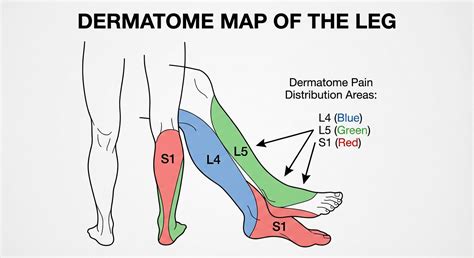 Sciatica Vs Piriformis Syndrome Key Differences