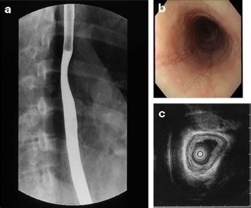 Figure 3 Eosinophilic Esophagitis Gi Motility Online