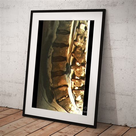 Sciatica Mri Scan Poster By Science Photo Library Science Photo Gallery