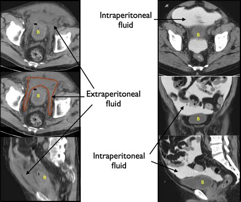 Applied Peritoneal Anatomy Clinical Radiology