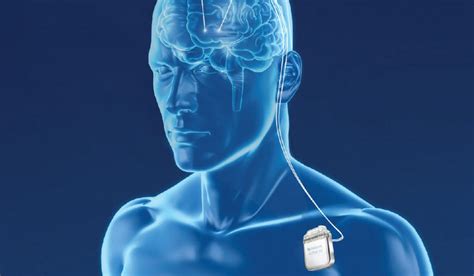 Discoveries In Medicine From Hope To Practice Deep Brain Stimulation For Epilepsy Now Available