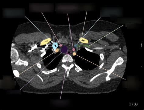 Radiology Case Stack 10 Axial Soft Tissue Window 3 Diagram Quizlet