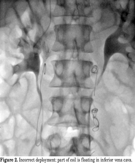 Figure 1 From Complications And Side Effects After Pelvic Vein