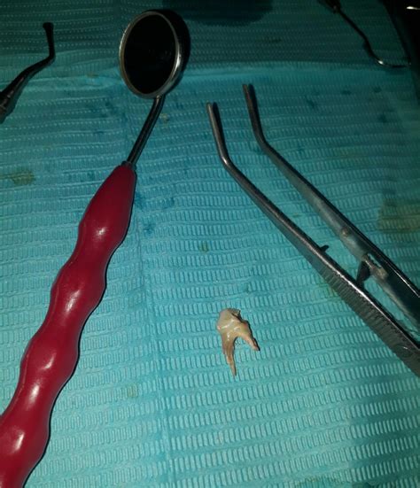 Deciduous Teeth Extraction Done Itulid Dental Clinic