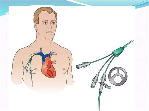 Central Venous Access Catheter Central Venous Catheter Catheter