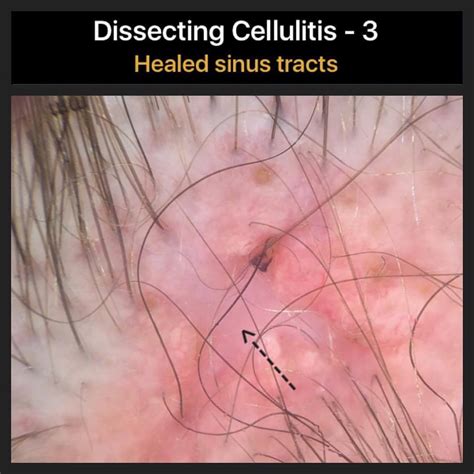Blog Of A Hair Loss Physician — Dissecting Cellulitis Dsc Is A Rare