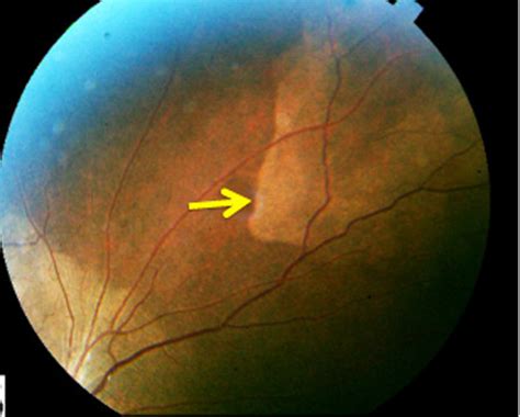 White Without Pressure The Retina Reference