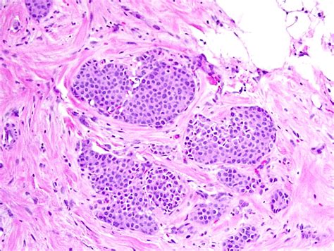 Dcis Vs Lcis Pathology Student