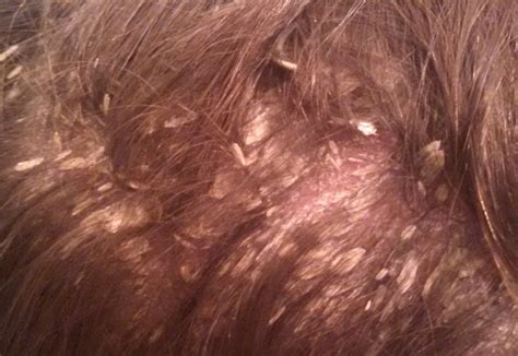 Seborrheic Dermatitis What Is It