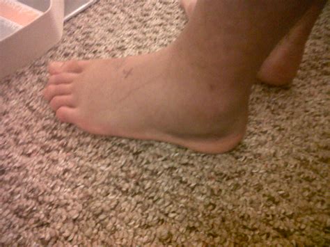 Fractured Tibia And Fibula Broken Lower Leg Bones With Fixation