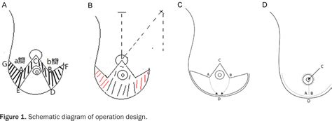 Figure 1 From The Combination Of Inferior Pedicle Method And Dermal