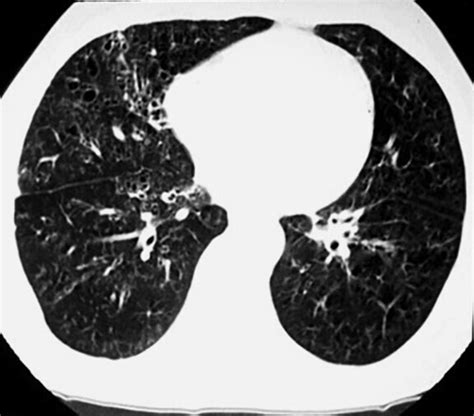 Bronchiolitis
