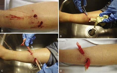 Principles Of Wound Management Clinical Gateclinical Gate
