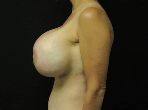 Extra Large Breast Augmentation Case