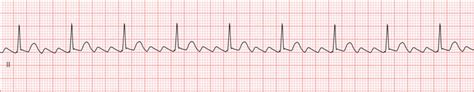 Atrial Flutter The Medical Cookbook