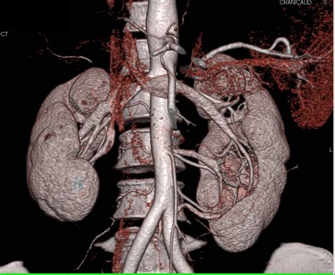 Multiple Left Renal Arteries And Duplication Of The Left Collecting