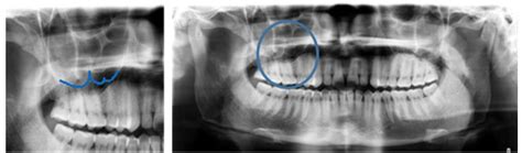 Panoramic Radiograph Showing Septa In Maxillary Sinus Download Scientific Diagram