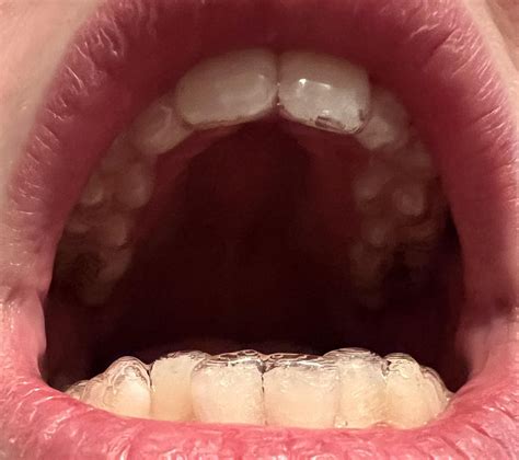 Invisalign Not Tracking Rinvisalign