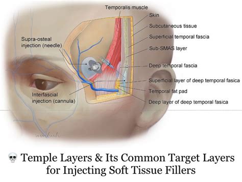 yousef nazari on linkedin 💀 temporal fossa augmentation 🔻injection