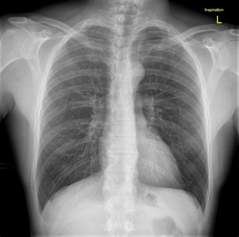 Xray Of Broken Ribs