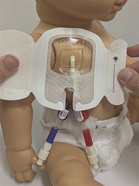 Haemodialysis Line Permcath Leeds Teaching Hospitals Nhs Trust