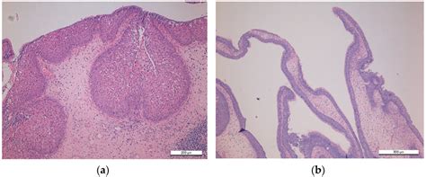 Two Different Histological Types Of Sinonasal Squamous Cell Papillomas