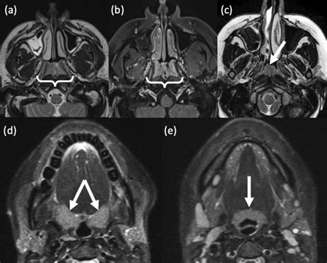 Imaging Of Pharyngeal Pathology Pmc