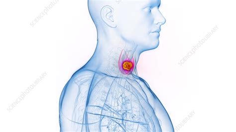 Animation Of A Malignant Tumor In A Mans Thyroid Gland Stock Video Clip K012 0898 Science