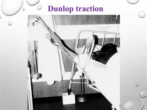 Splint Ppt By Rupeshkumar Pptx