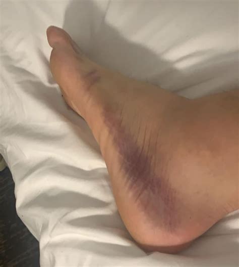 Rolled Ankle Rmedical